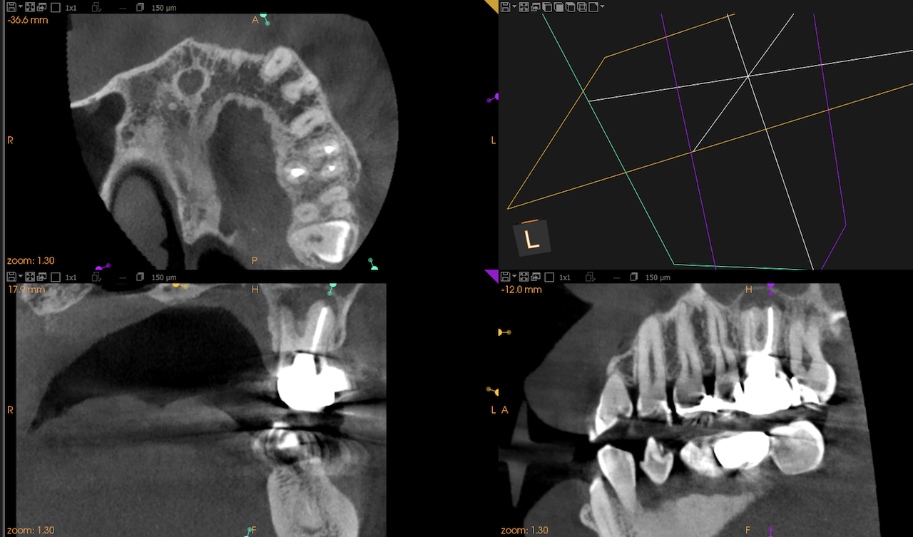 Apico-Marginal Defectを人為的に作成すると…〜#14 Intentional Replantationとその1yr ...